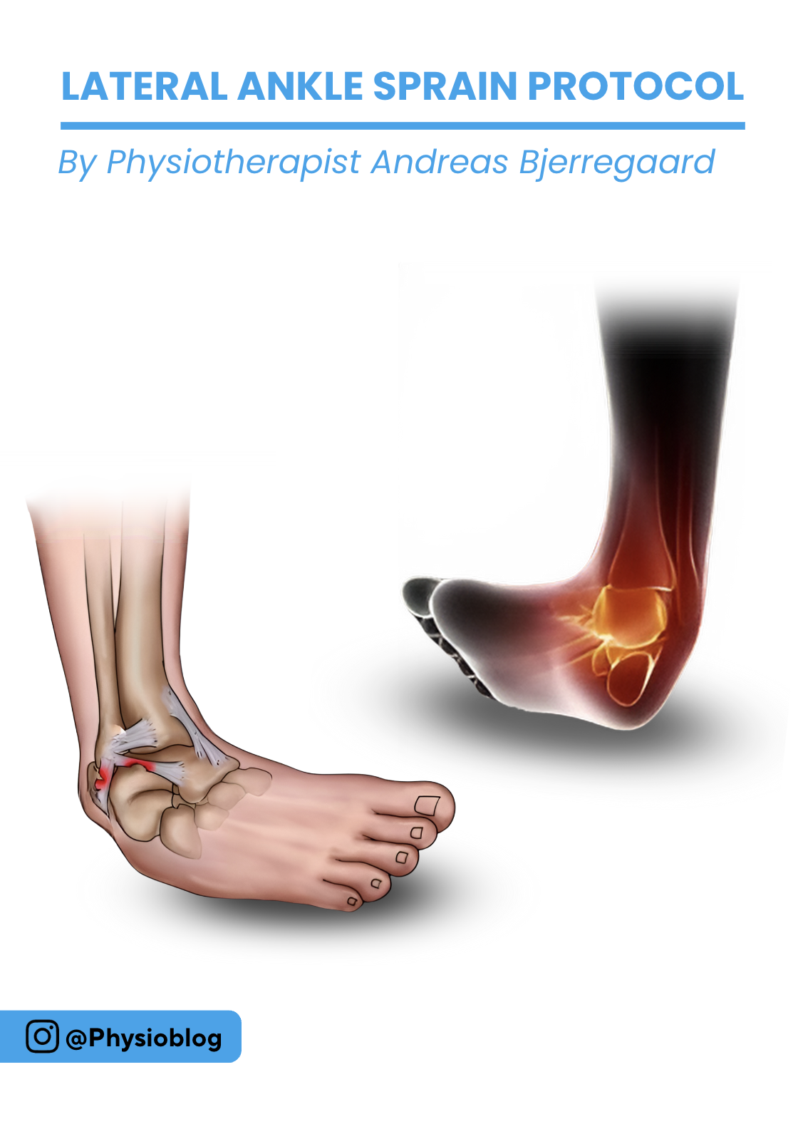 Ebook: Lateral ankle sprain - Physioblog by Andreas Bjerregaard